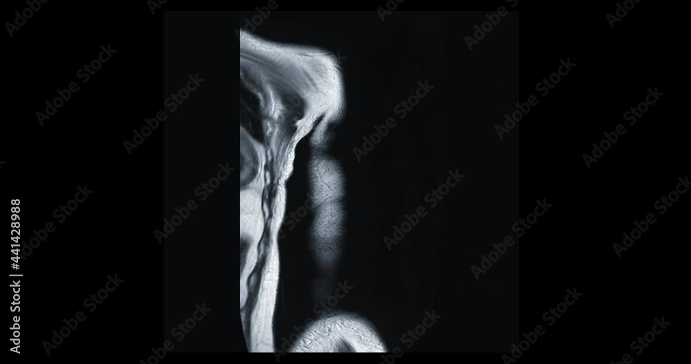 MRI Arm or humerus bone , Magnetic resonance imaging of Arm or humerus ...