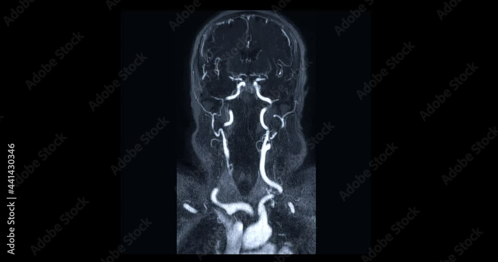 Contrasted of MRA Brain or Magnetic resonance angiography of the brain ...