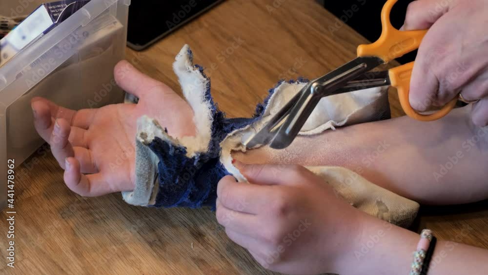 A broken arm in arm cast. A woman with scissors cuts the cast to get it ...
