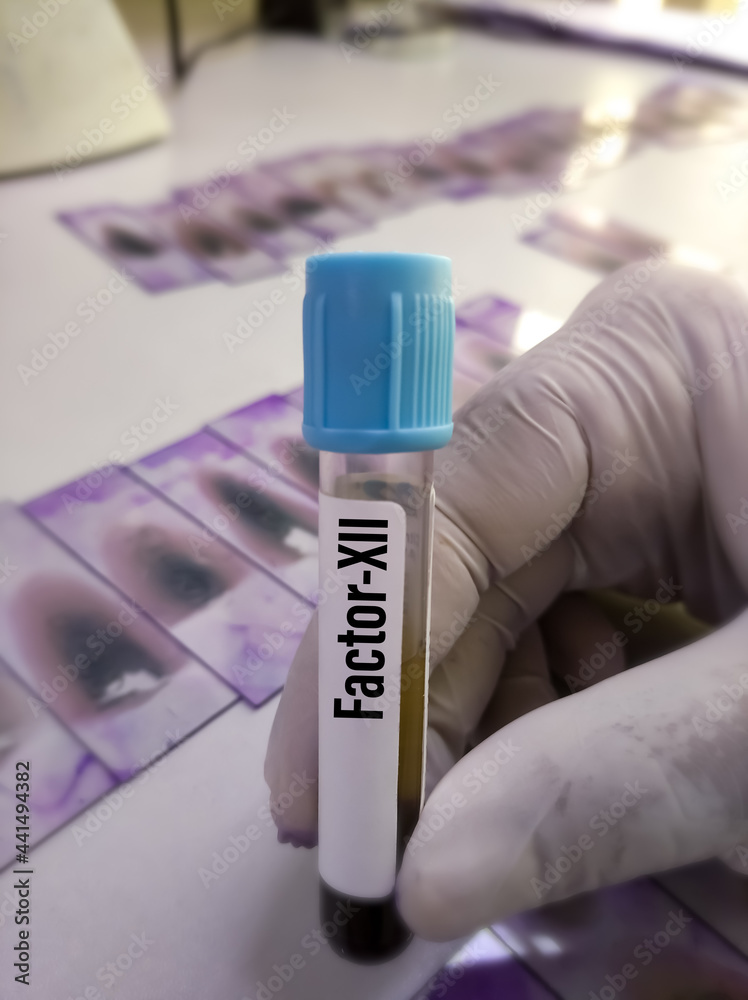 Blood sample for Factor XII or Hageman factor test, diagnosis of ...
