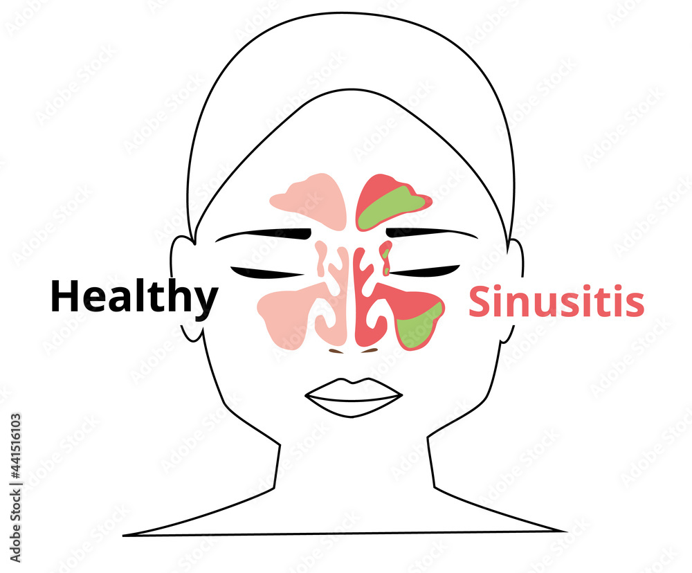 Sinusitis medical treatment. Nasal sinus. Healthy and inflammation ...