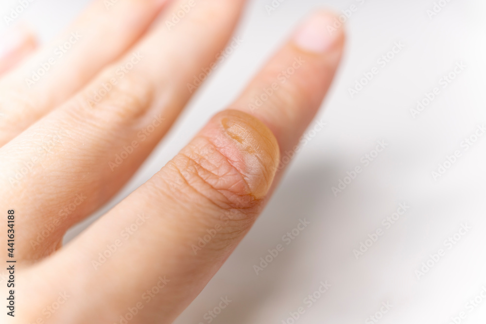 There is a blister on woman's hand from a burn. Burn of the finger. A ...