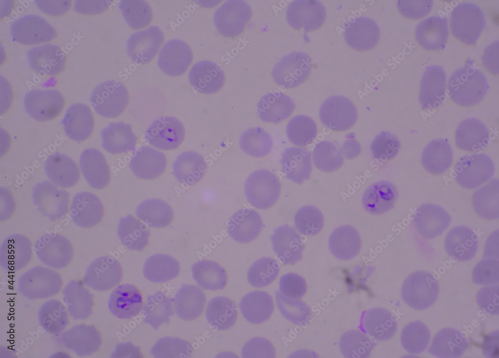 Blood parasite ring form Malaria infected red blood cells. Stock Photo ...