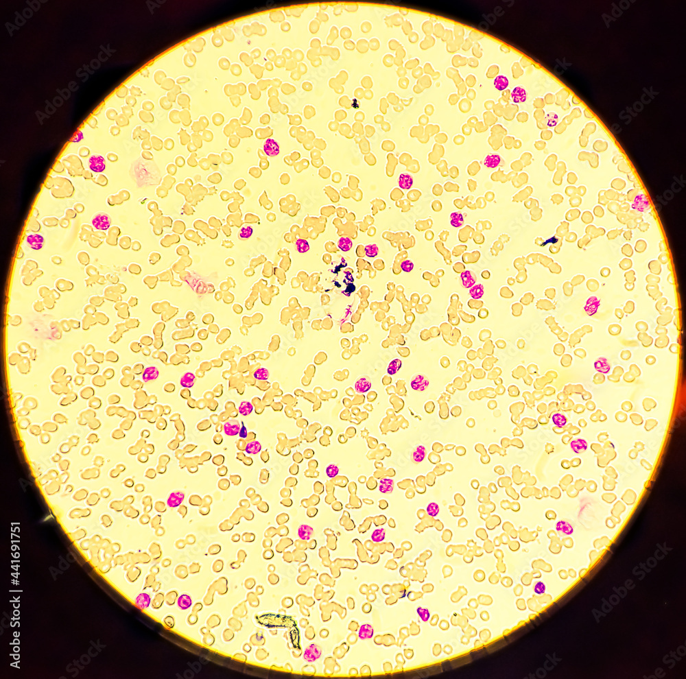 Blood smear under microscopy showing on Adult acute myeloid leukemia ...