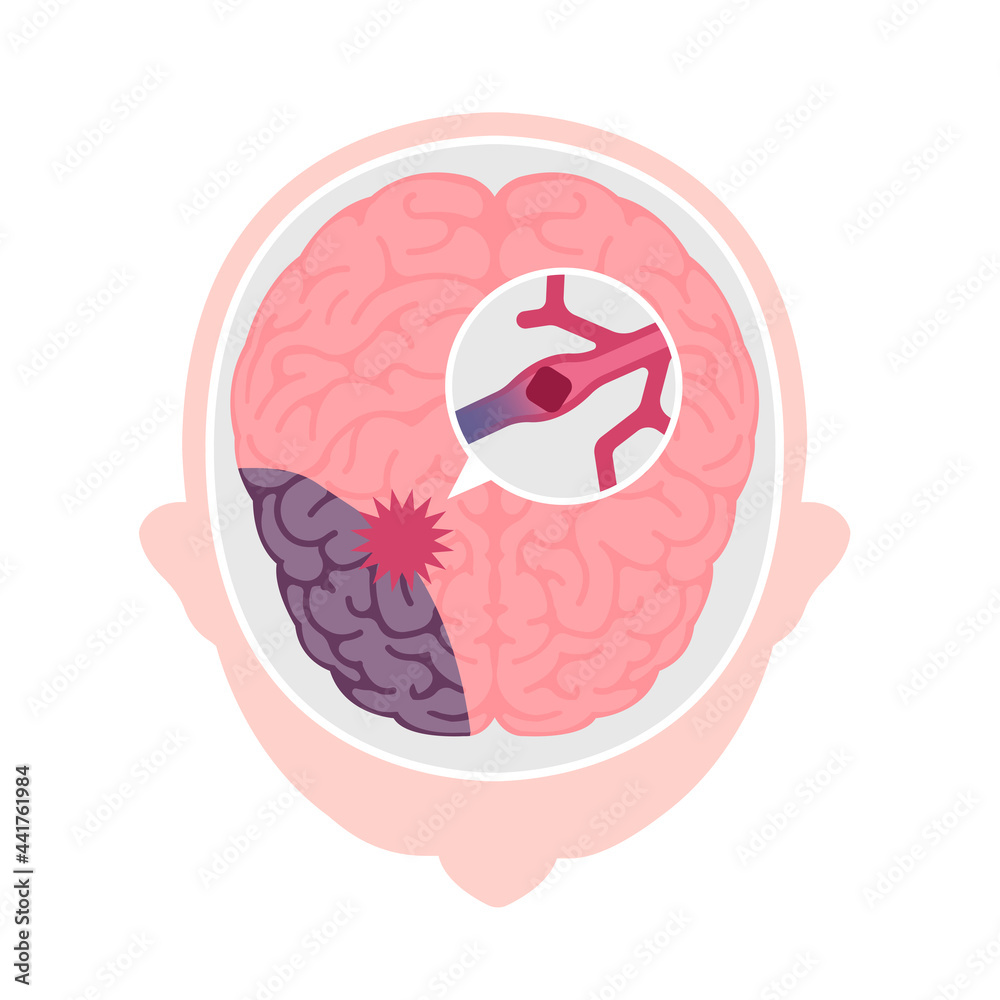 Types of human brain stroke vector illustration | Cerebral infarction ...