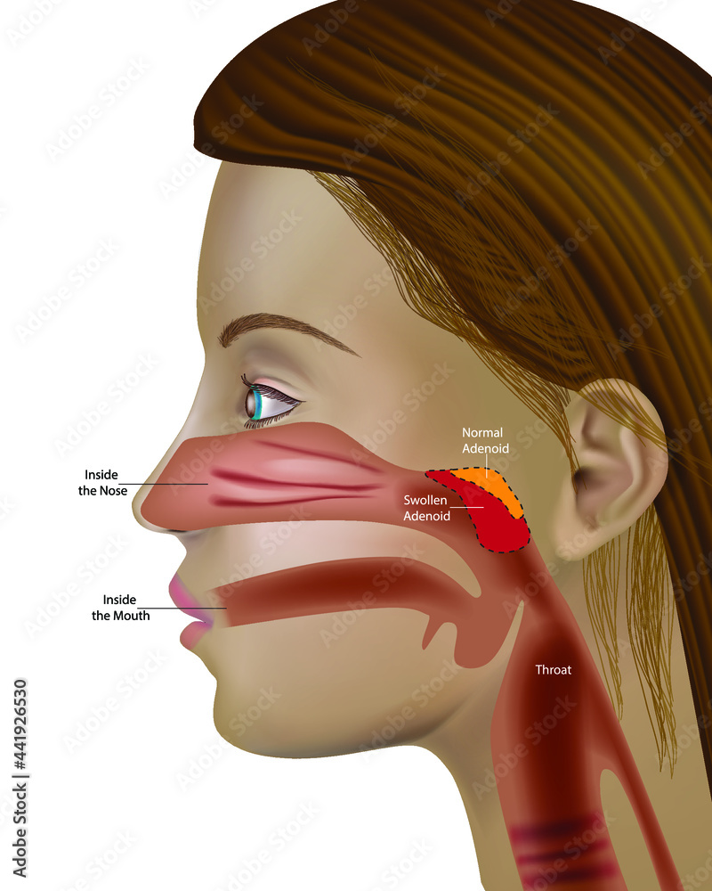 Adenoids Pharyngeal Tonsil Or Nasopharyngeal Tonsil Human Anatomy Otolaryngology Adenoid