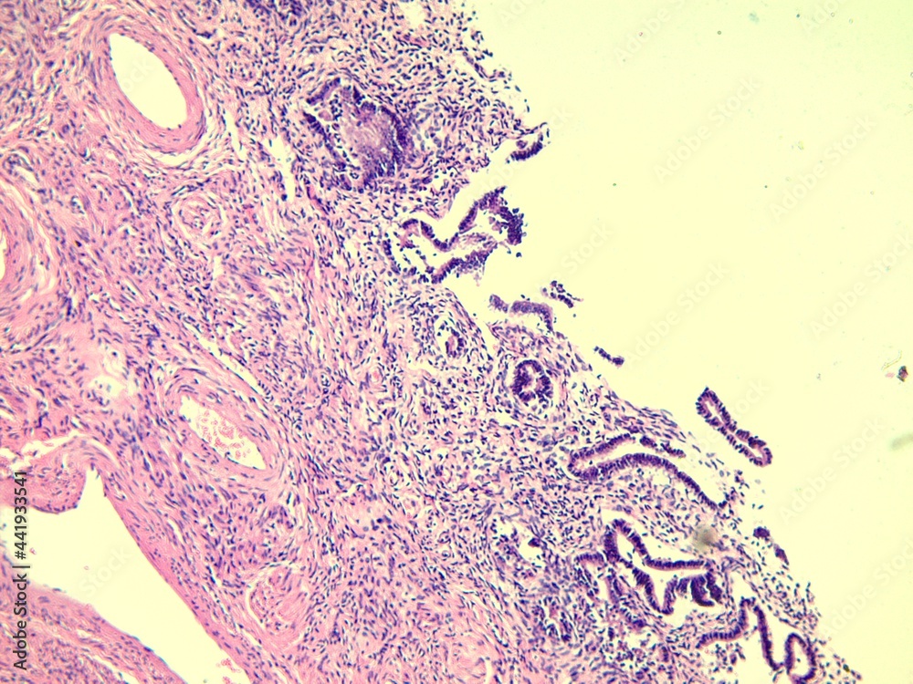 Endometrial adenocarcinoma, uterus wall carcinoma,photo under ...