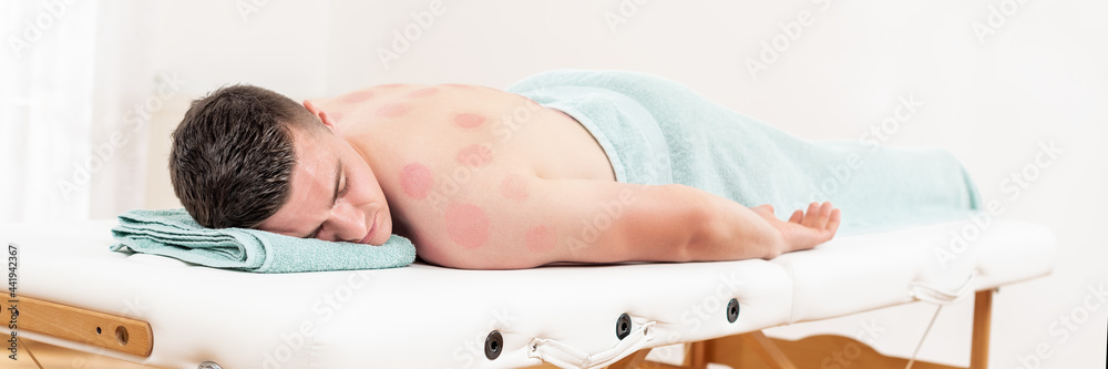 Young man relaxing after vacuum cupping therapy. Back with skin ...