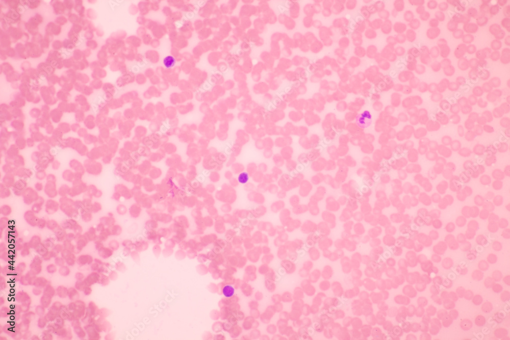Human blood smear view in microscopy.Complete blood count for treatment ...