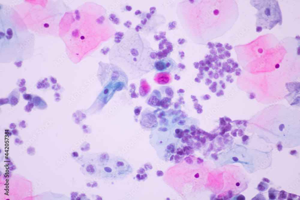 View in microscopic of Abnormal human cervix cells.Squamous epithelium ...