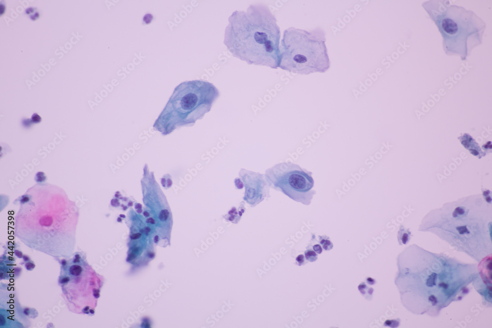 Fototapeta Artystyczne View in microscopic of Abnormal human cervix ...