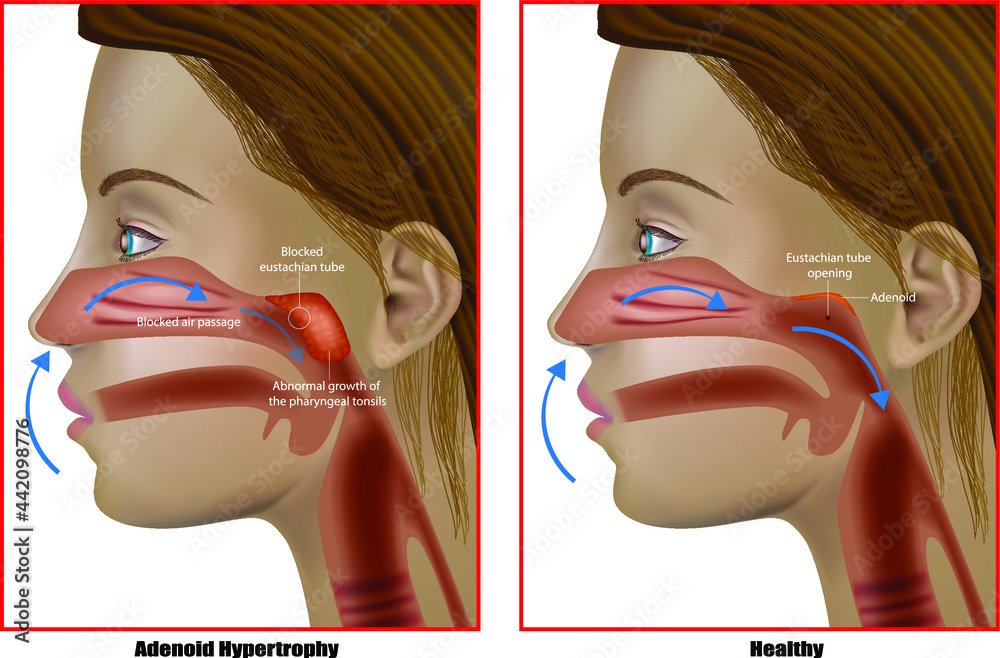 Adenoid hypertrophy, the abnormal growth of the pharyngeal tonsils ...