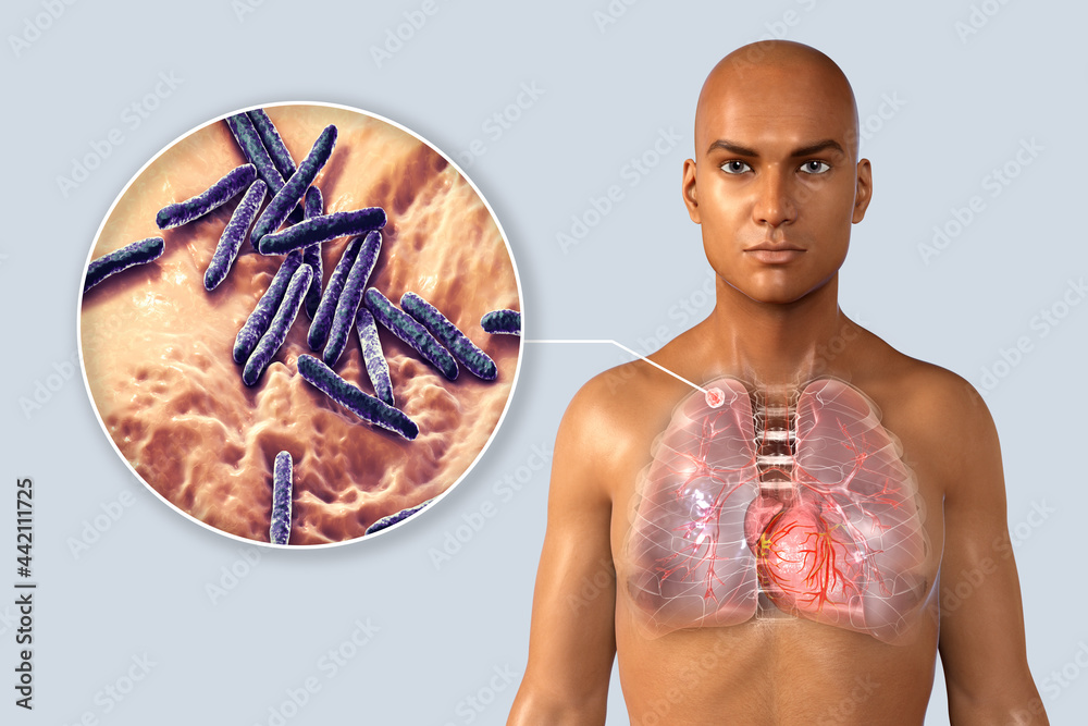 Lung tuberculosis and close-up view of bacteria Mycobacterium ...