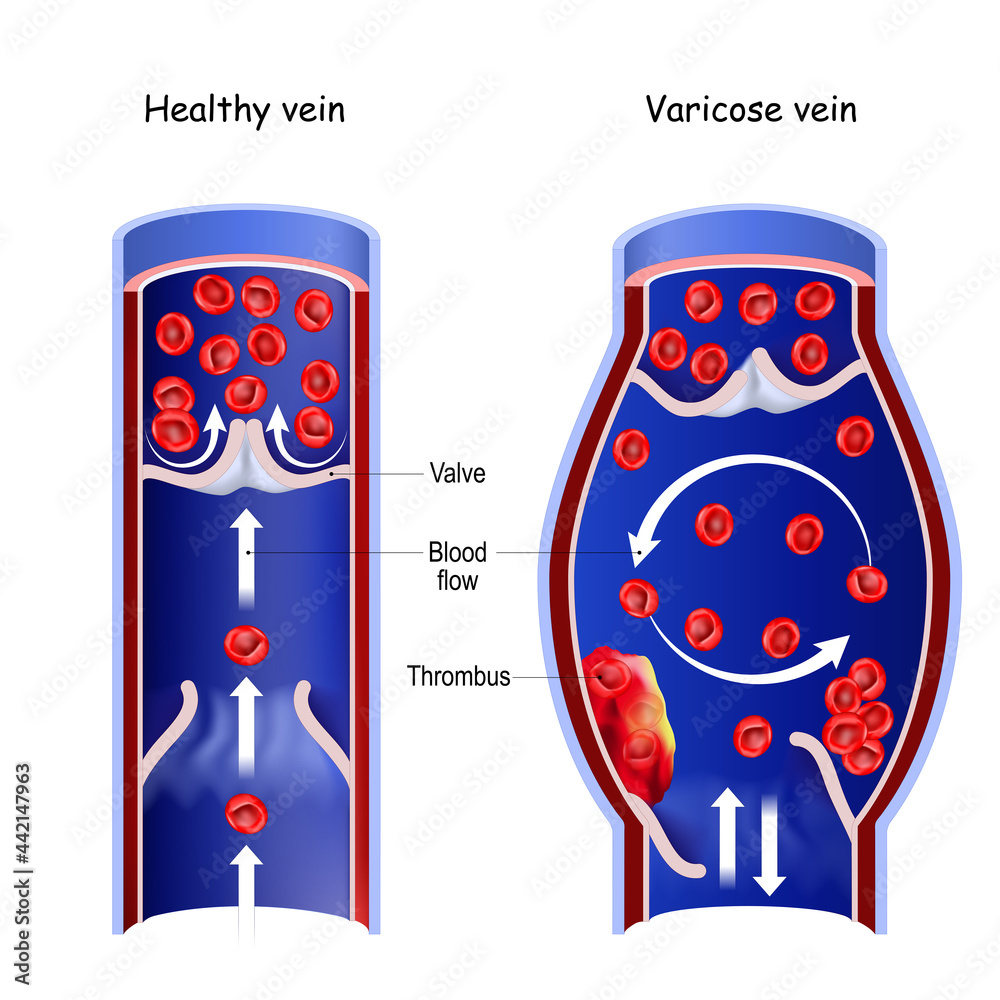 Healthy vein, and varicose vein. Cross section of a blood vessel Stock ...