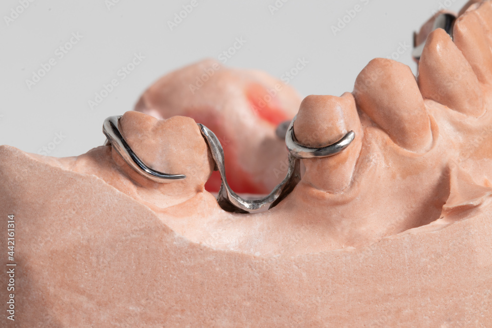 Dental stone model with removable partial denture framework. Stock ...