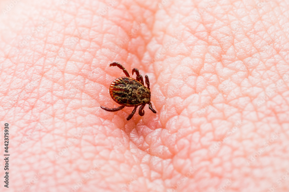 Infectious Encephalitis Tick Insect on Skin. Encephalitis Virus or Lyme ...
