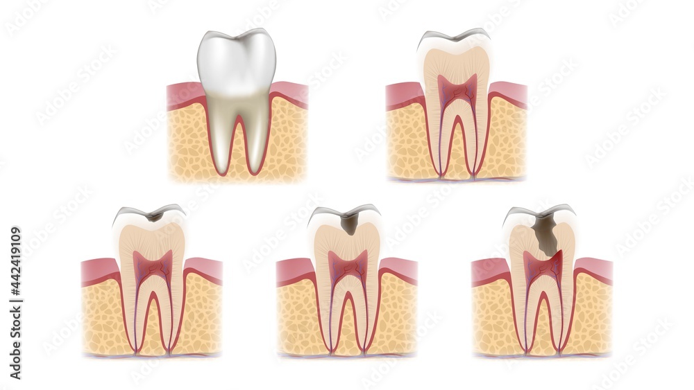 Póster A schematic sectional view of the stages of caries development ...