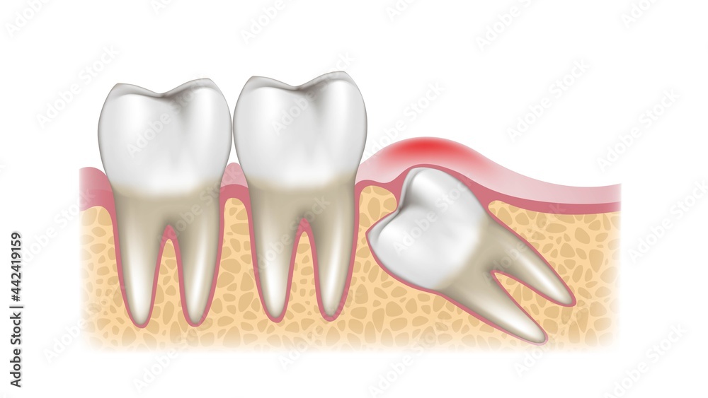 A schematic sectional view of a growing wisdom tooth Stock Vector ...