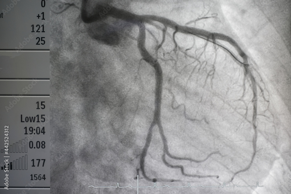 Póster coronary artery angiography ,Coronary artery disease , left ...