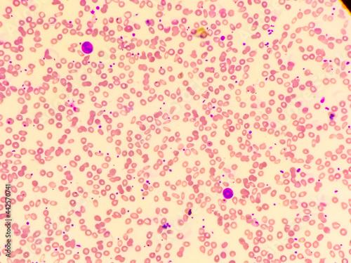 Iron deficiency Hypochromic microcytic anemia, red blood cells in a ...