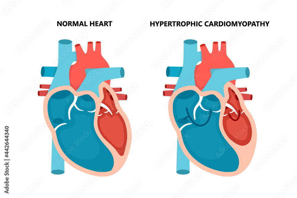 Hypertrophic cardiomyopathy with cross-section view. Human heart muscle ...