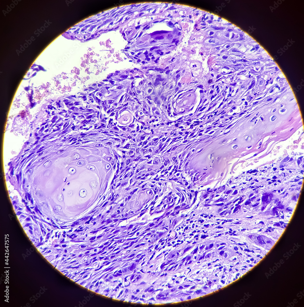 Invasive Squamous Cell Carcinoma Of Vocal Cord Polyp Show A Malignant
