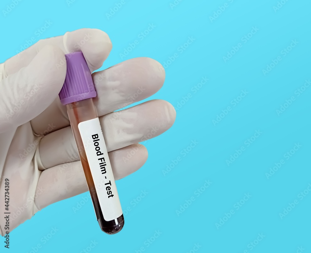 Biochemist holds Blood sample in a lavender tube for Blood Film testing ...
