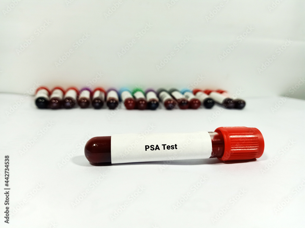 Blood sample for PSA test. Doctor or Scientist holding tube for ...