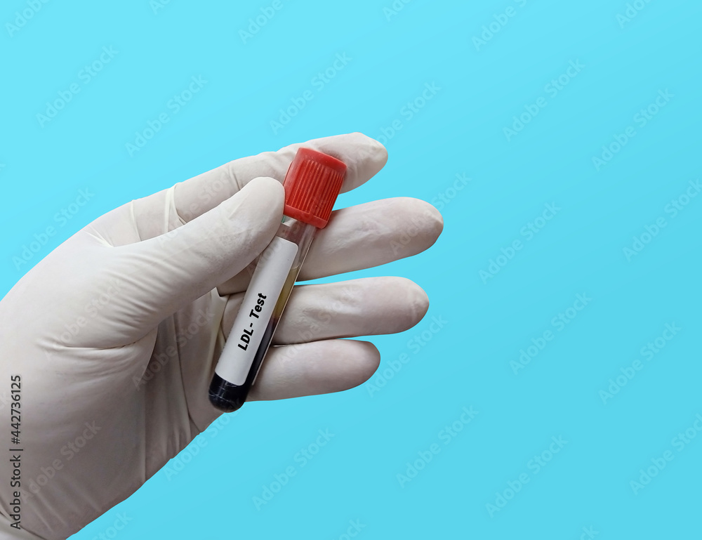 Blood sample for LDL (low-density lipoprotein) test. Lipid profile. Bad ...