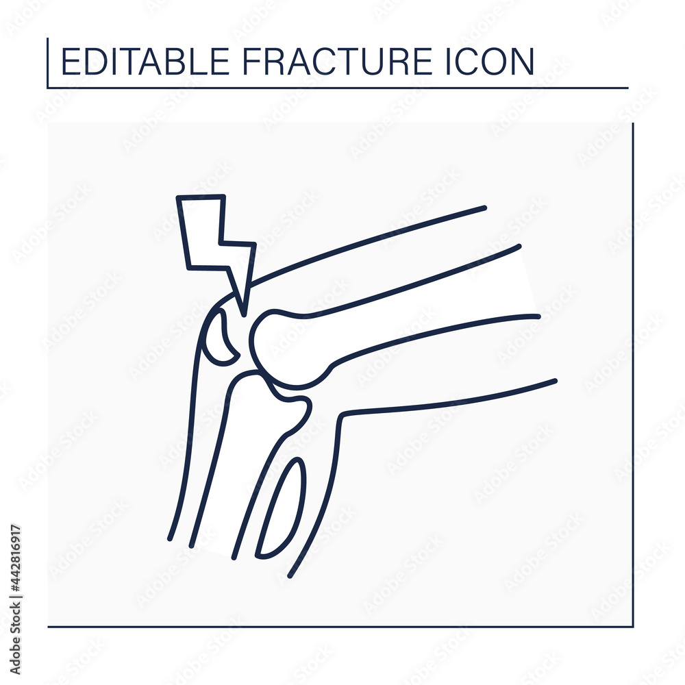 Stress fracture line icon. Fatigue-induced bone fracture caused by ...