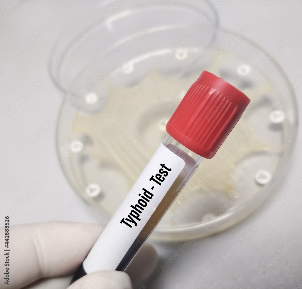 Test Tube with blood sample for Typhoid test with sensitivity plate ...
