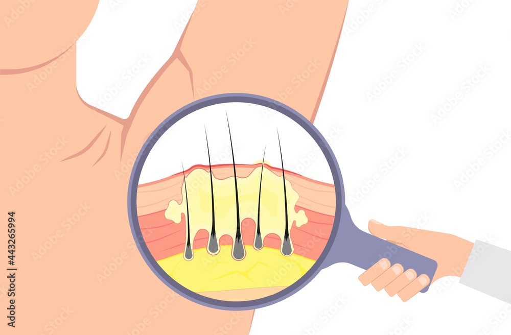 Ingrown Hair Cyst Armpit