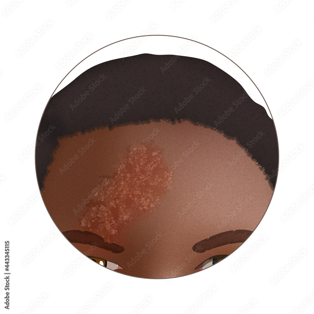 Shingles, herpes zoster. Painful skin rash with blisters on the brown ...