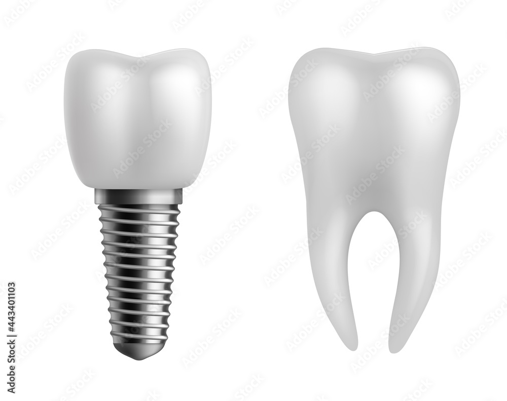 Dental implant and teeth. Realistic orthodontic elements. Human white ...