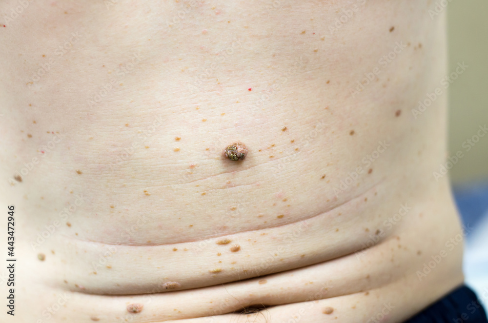 External skin diseases. Rash on the skin of a man in the form of moles ...