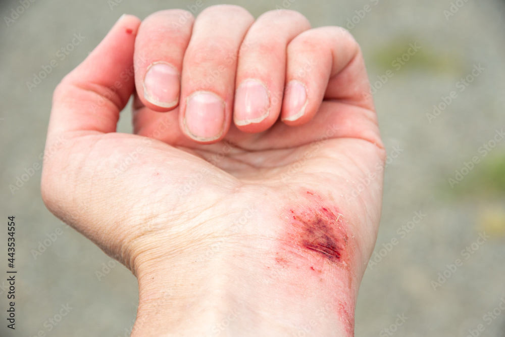 Red wound on the palm, arm, wrist after a burn or fall. First aid in ...