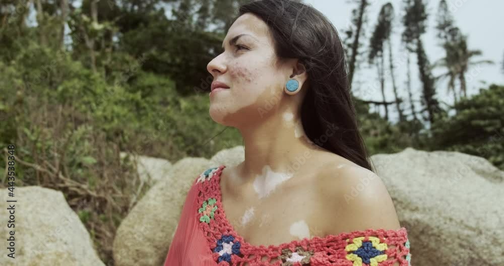 Beautiful latin girl with vitiligo on the beach. World Vitiligo Day ...