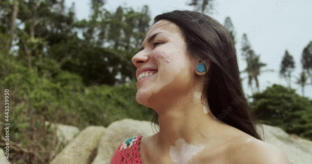 Beautiful latin girl with vitiligo on the beach. World Vitiligo Day ...
