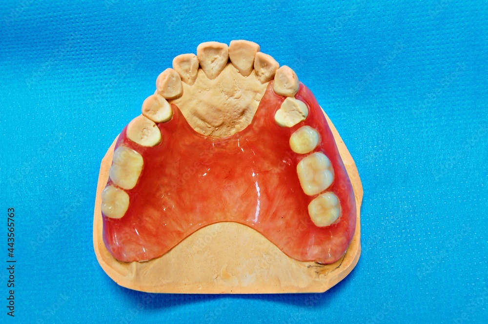 maxillary aesthetic partial dentures Stock Photo | Adobe Stock