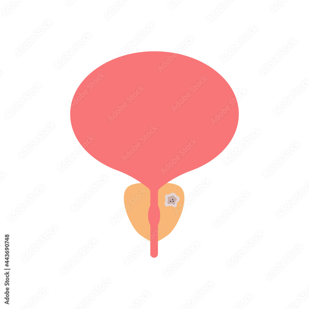Prostate cancer flat illustration. Bladder, infertility, prostatitis ...