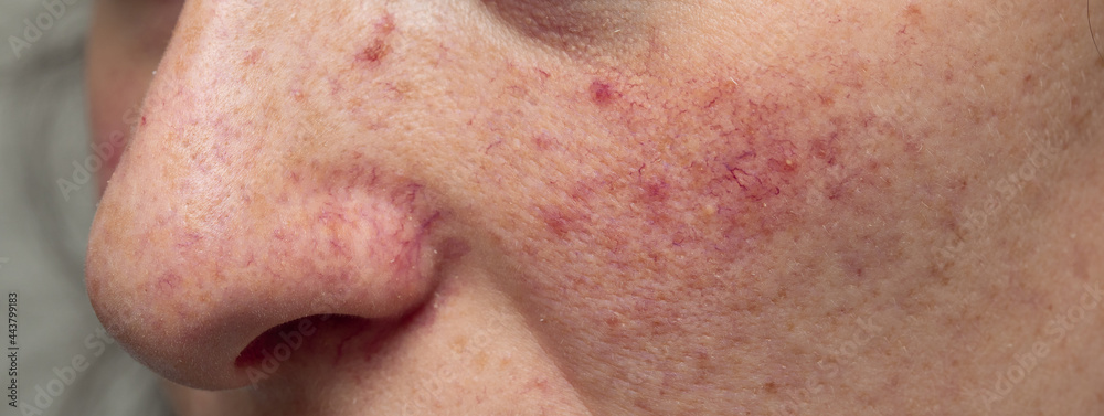 Close up view of young caucasian girl face suffering from rosacea ...