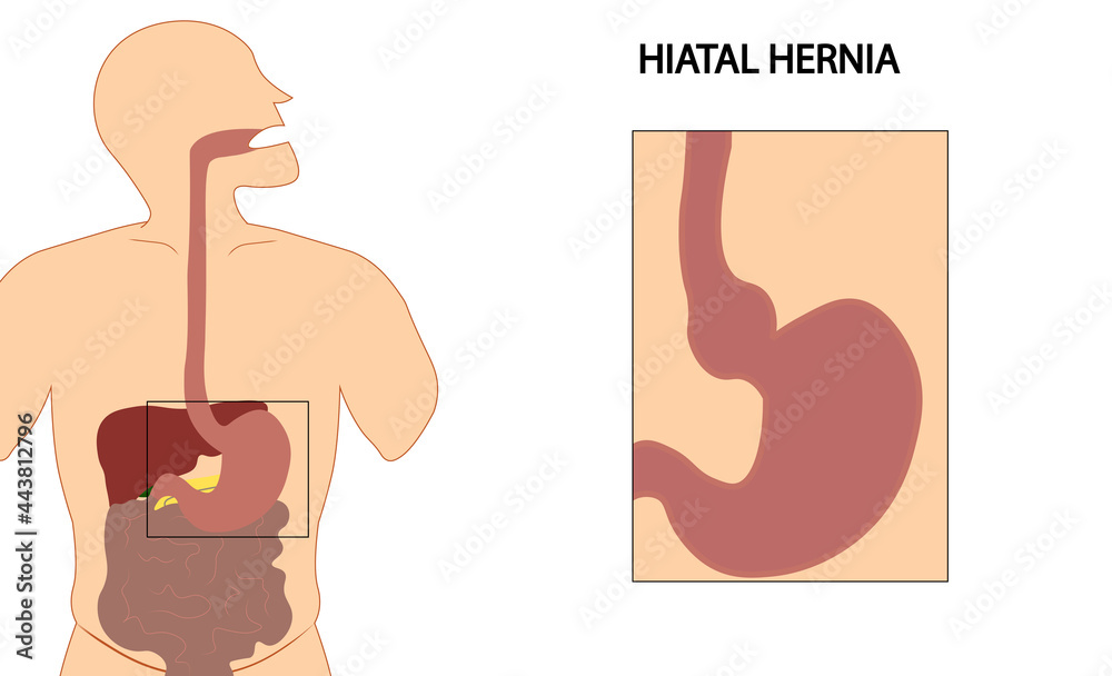 Hiatus hernia. Hiatal hernia. Types of hiatal hernia illustration Stock ...