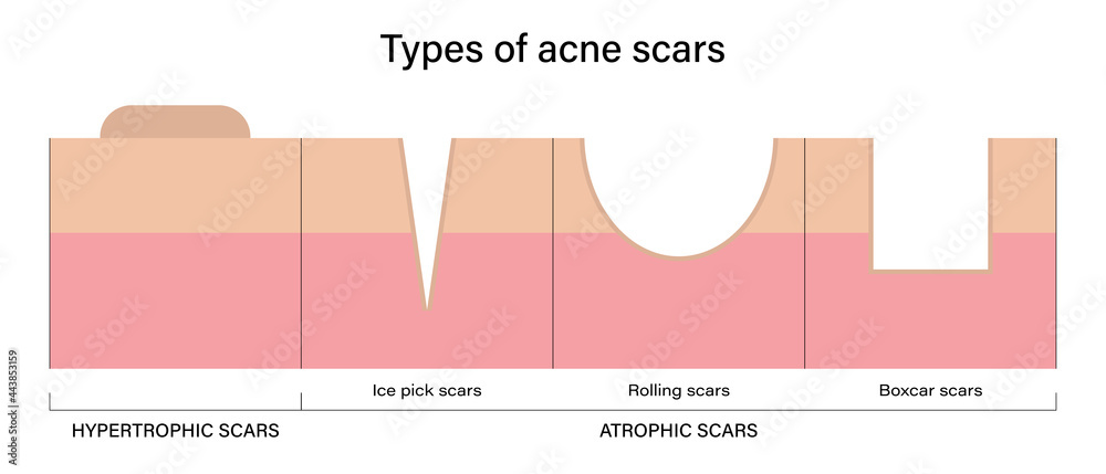 Types of acne scars vector. Acne scar analysis Stock Vector | Adobe Stock