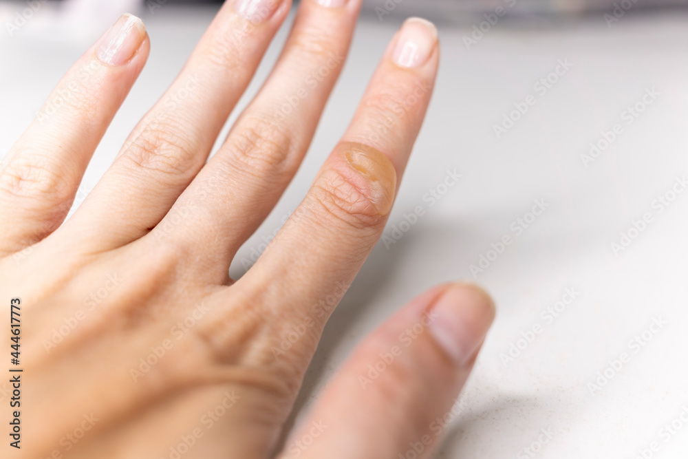 There is a blister on woman's hand from a burn. Burn of the finger. A ...