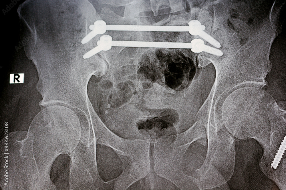 selective focus Plain x ray with a fracture pelvis that is fixed with 4 ...