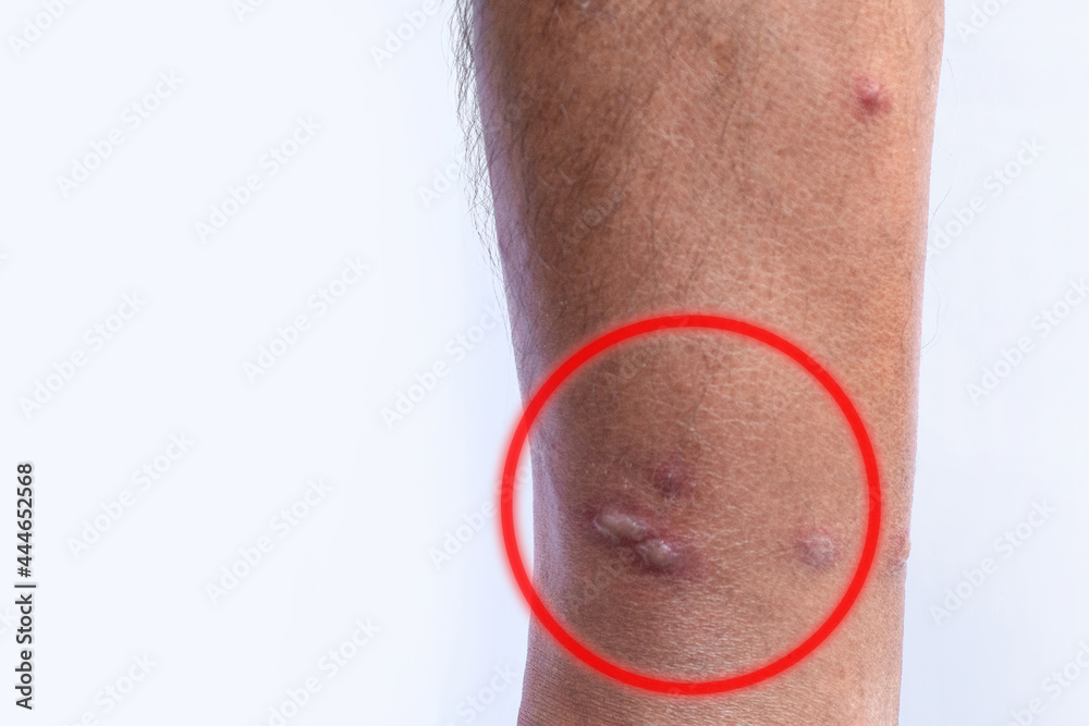 Man shin with blisters are caused by insect bite, close-up of the ...