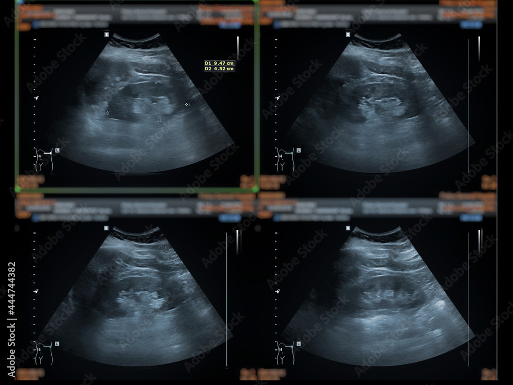 Ultrasound upper abdomen showing Liver, gall bladder and kidney for ...