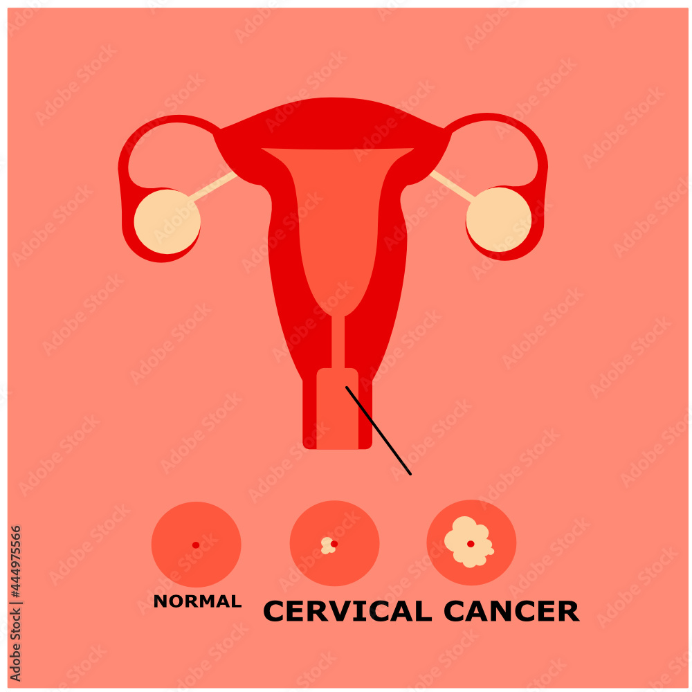 Vector illustration of uterus with cervical cancer. Stages of cervical ...