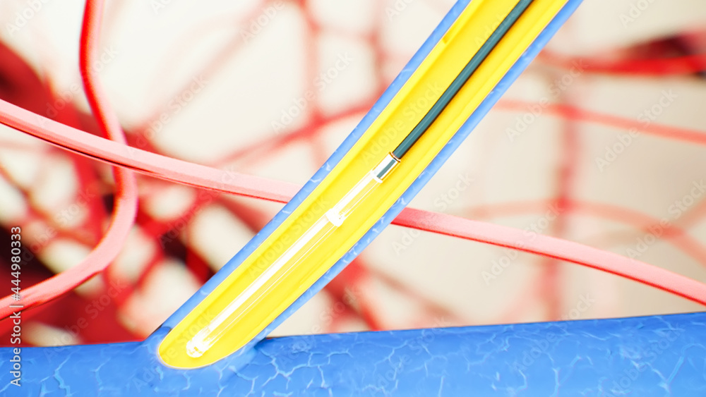 Laser surgery to remove varicose veins, laser insertion into a vein ...