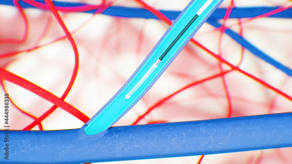 Laser surgery to remove varicose veins, laser insertion into a vein ...